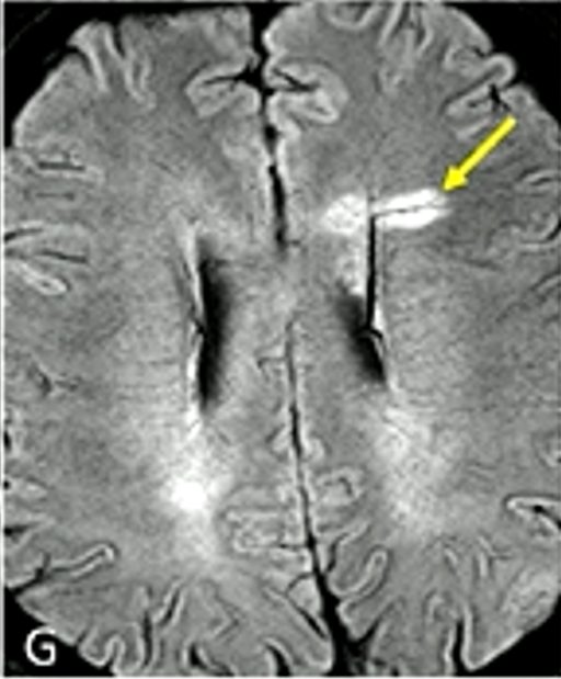 Revamping the Diagnosis Criteria for Multiple Sclerosis - Rocky ...