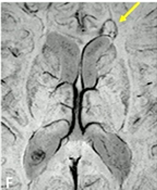 Revamping the Diagnosis Criteria for Multiple Sclerosis - Rocky ...